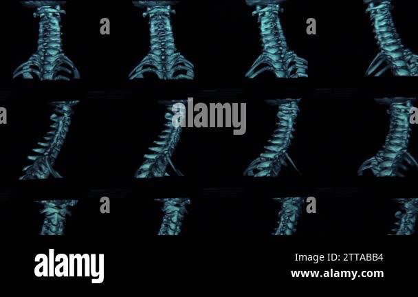 Vertebral column, Spine, MRI Scan, Human Body Xray Monitor Stock Video ...