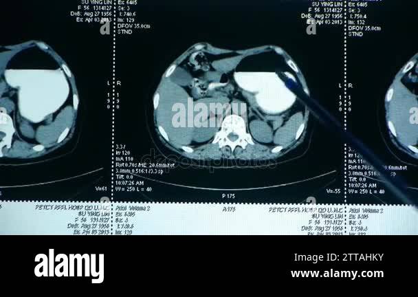 China-Sep 08,2017:doctor study Gallbladder pet-ct scan,human organ X ...
