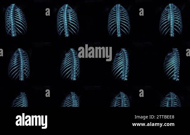 Thorax xray Stock Videos & Footage - HD and 4K Video Clips - Alamy