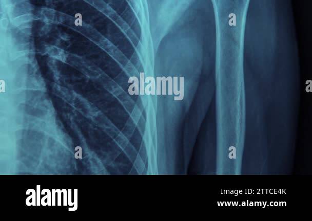 MRI Scan Broken Collar Bone (Broken Clavicle), Human Body Xray Monitor ...