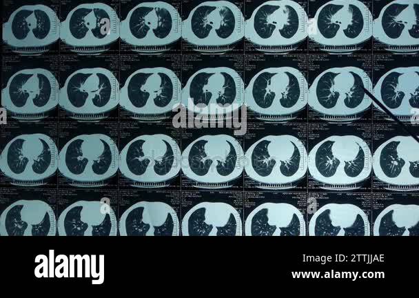 Ct Scan Thorax Lung Cancer Stock Videos And Footage Hd And 4k Video 7965