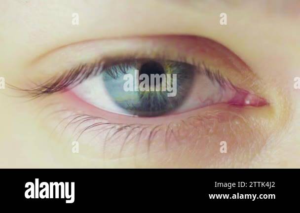 Macro View of Pupil Constriction Process in Human Eye. Constriction of ...