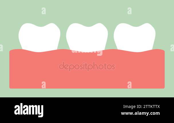 plaque on gum before gingivitis or gum disease - dental cartoon vector ...