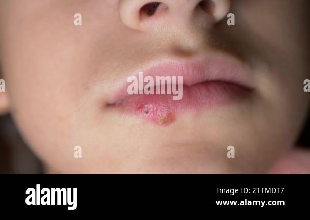 herpes on the lips of a boy. herpes. lip treatment. 4k, slow-motion ...