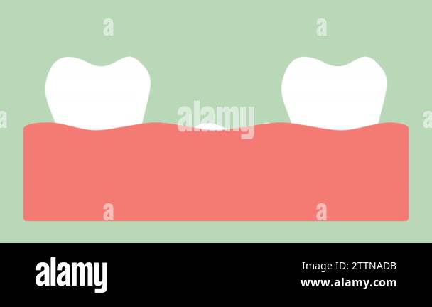 spacing teeth ( diastema ), space between tooth in mouth - dental ...