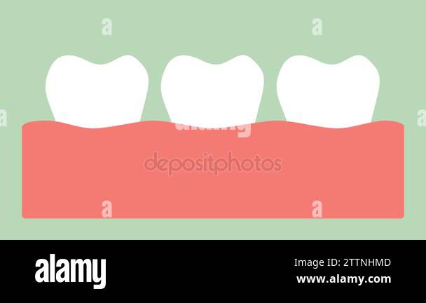 gingivitis or gum disease with bleeding, gum inflammation before ...