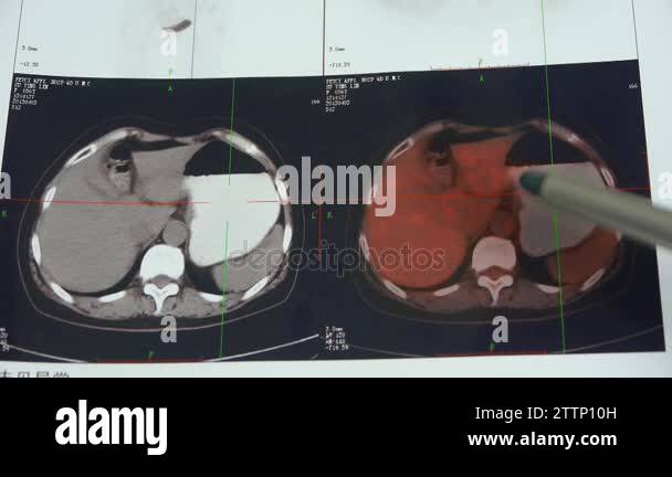 Stomach cancer scan Stock Videos & Footage - HD and 4K Video Clips - Alamy