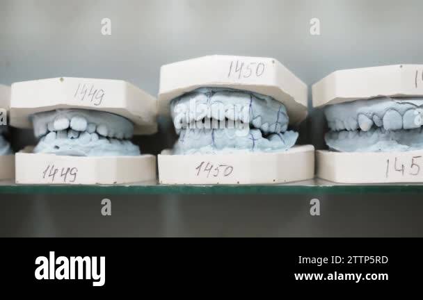 Gypsum impression of a human bite Stock Videos & Footage - HD and 4K ...