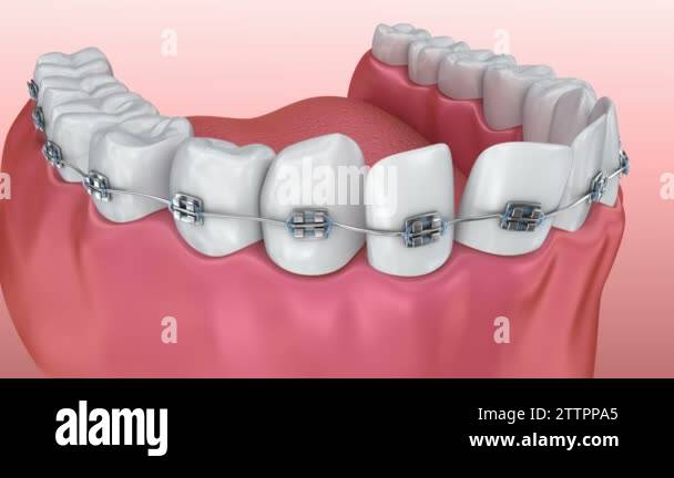 Teeth with braces Alignment process. Medically accurate 3D animation ...