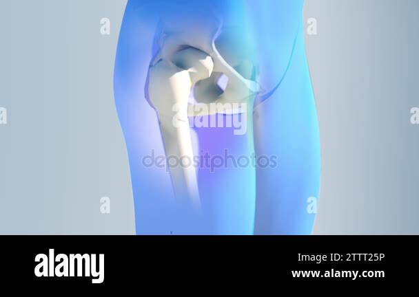 Hip replacement implant installed in the pelvis bone. Medically ...