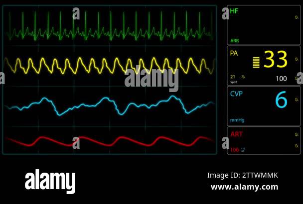 Looped: Patient monitor displays vital signs ECG electrocardiogram EKG ...