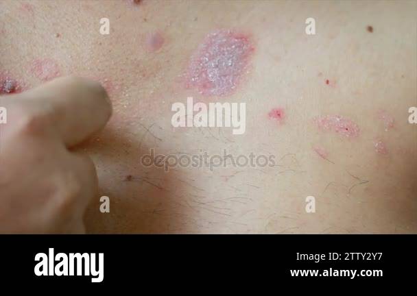 4K Close up shot hands of man scratching skin rash Dermatitis psoriasis ...