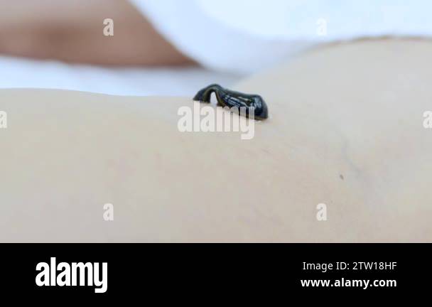 Leech on skin Stock Videos & Footage - HD and 4K Video Clips - Alamy
