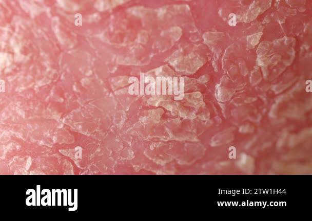 CLOSE UP, MACRO: Detail of dry silver scales covering red inflamed skin ...