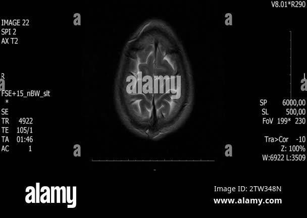 Real life man brain mri scan with tumor neoplasm medical reseach new ...