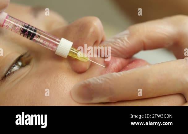 process of lip augmentation of hyaluronic acid. patient during lips ...