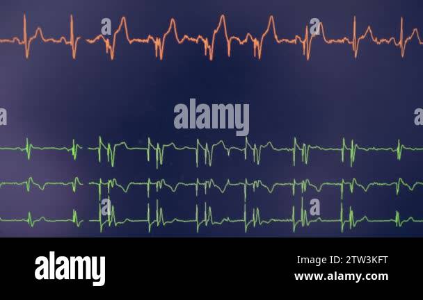 Real ecg screen Stock Videos & Footage - HD and 4K Video Clips - Alamy