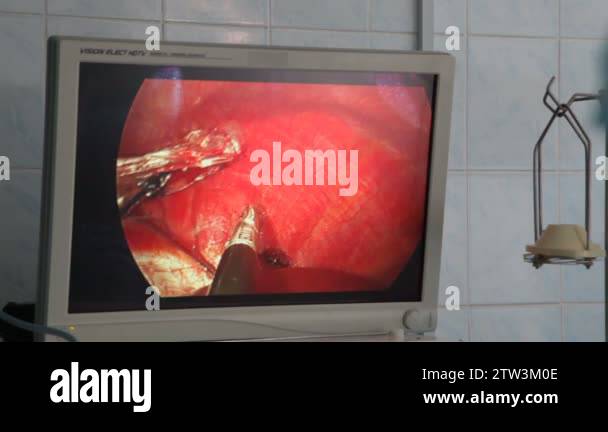 VINNITSA, UKRAINE, APRIL 10, 2018: Removal of malignant tumor in the ...