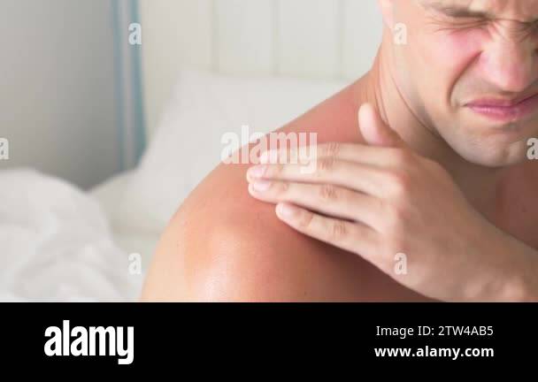 4k. a man smears his shoulders, received a sunburn, gel from burns. A ...
