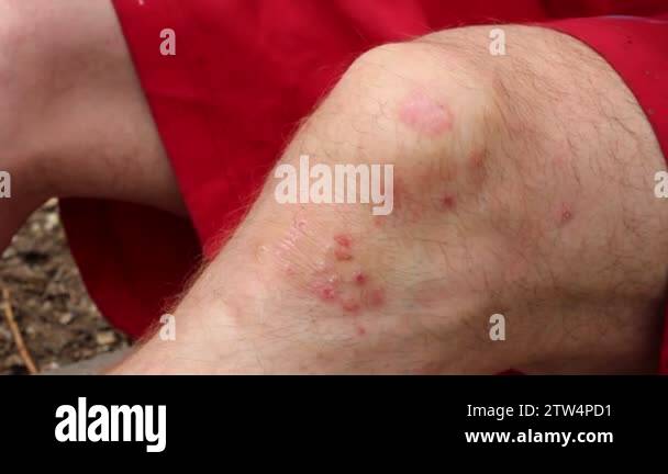 Plaque Psoriasis on elbow. The mainstay of psoriasis treatment, steroid ...