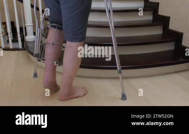Climbing the stairs on crutches with a broken leg in the Ilizarov's ...
