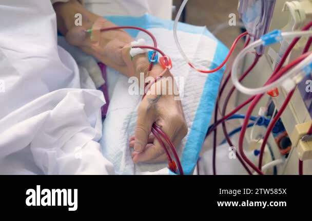 Renal dialysis shunt patient arm Stock Videos & Footage - HD and 4K ...