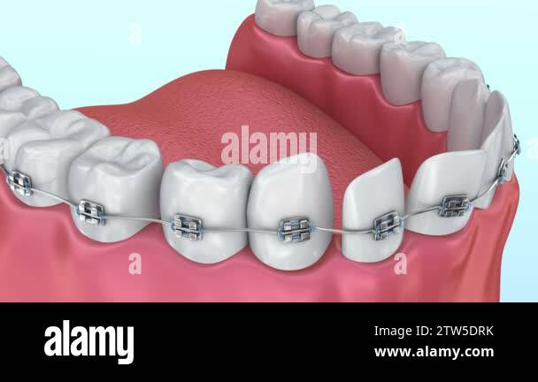 Curved braces Stock Videos & Footage - HD and 4K Video Clips - Alamy