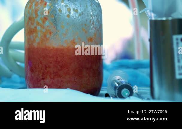 fat removal and Liposuction surgery Fat seeker. human fat in the glass ...