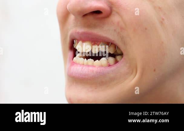 Correction of crooked teeth Stock Videos & Footage - HD and 4K Video ...