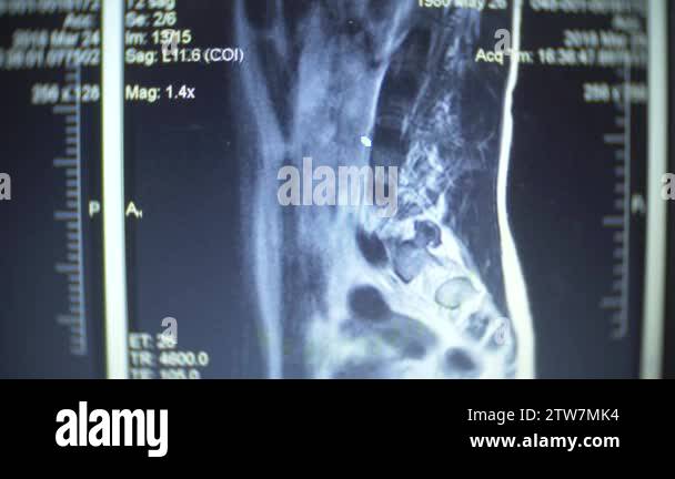 Close. MRI X-ray images. results of magneto resonance therapy on the ...