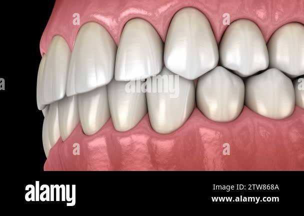 Healthy human teeth with normal occlusion, side view. Medically ...