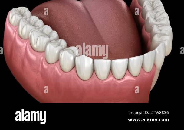 Premolar tooth recovery with implant. Medically accurate 3D animation ...