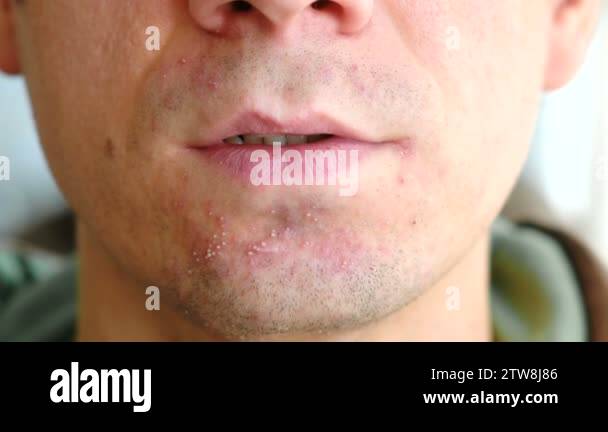 Shaving rash pimples Stock Videos & Footage - HD and 4K Video Clips - Alamy