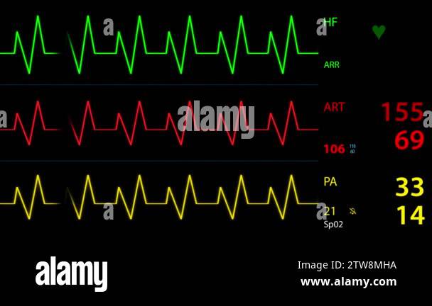 Looped: Patient monitor displays vital signs ECG electrocardiogram EKG ...