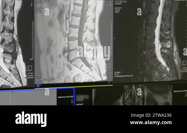 Spinal cord and spinal column tomography on MRI scan Stock Video ...