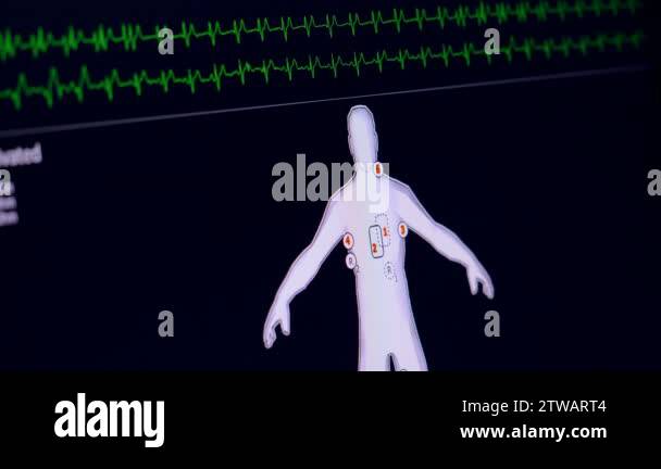 Patient monitor displays vital signs. Ecg, cardiogram concept Stock ... Patient monitor displays vital signs. Ecg, cardiogram concept Stock ...