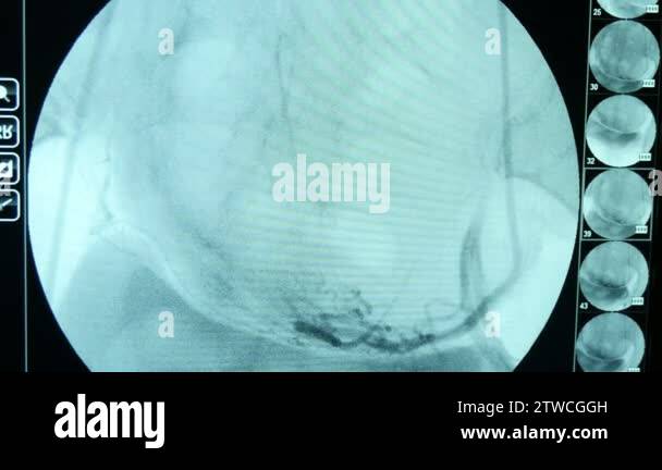 Examining a mammogram Stock Videos & Footage - HD and 4K Video Clips ...