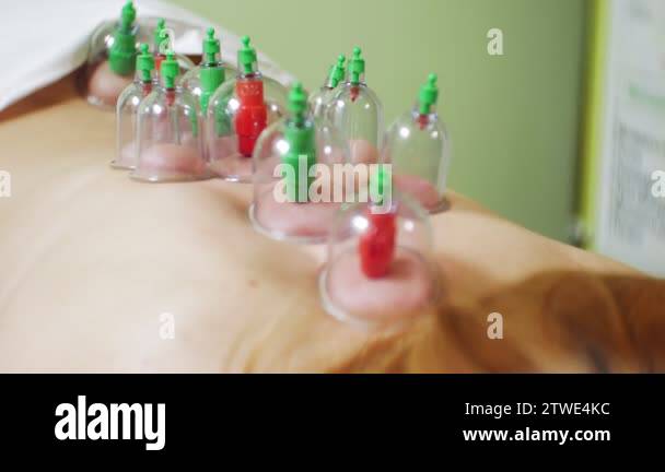 Traditional Chinese Medicine Cupping process. Hijamah Cups on back of female patient woman in ...