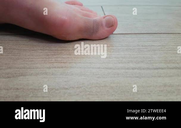 Bone deformation disease Stock Videos & Footage - HD and 4K Video Clips ...