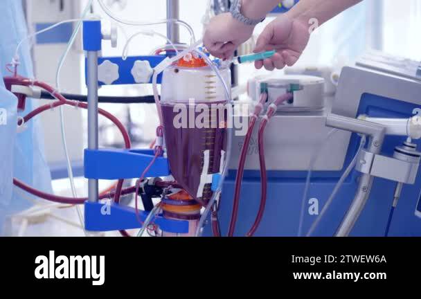 Dialysis medical device performing procedure Stock Videos & Footage ...