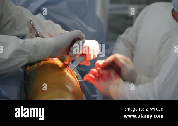 Orthopedic surgeons cut some human body using big screwdrivers and ...