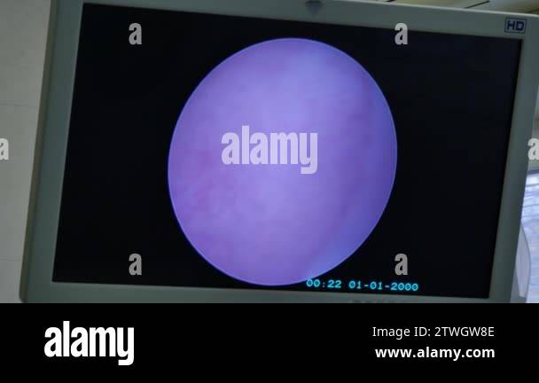 Female neck of uterus womb cervix uteri on monitor gynecological ...