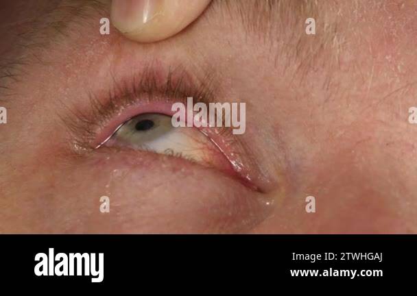 eye inflamnmation after hard work at the computer, man dripping liquid ...