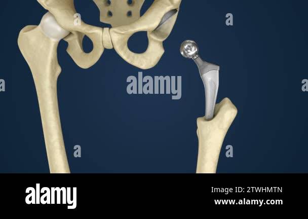 Hip replacement implant installed in the pelvis bone. Medically ...