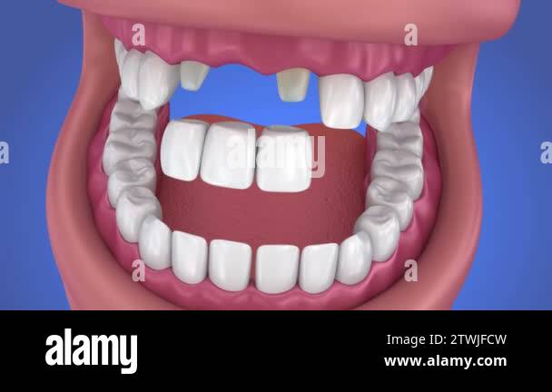 Tooth supported fixed bridge. Medically accurate 3d animation Stock ...