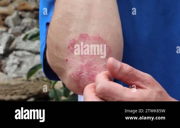 Patches of plaque psoriasis. The condition in flare-ups. The dry flakes ...