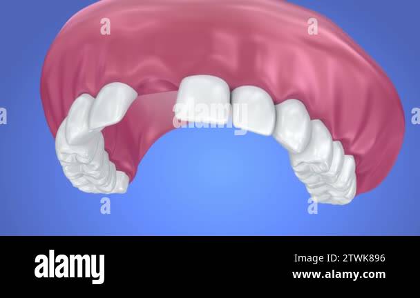 Single Missing Tooth - Removable partial denture. 3d animation Stock ...