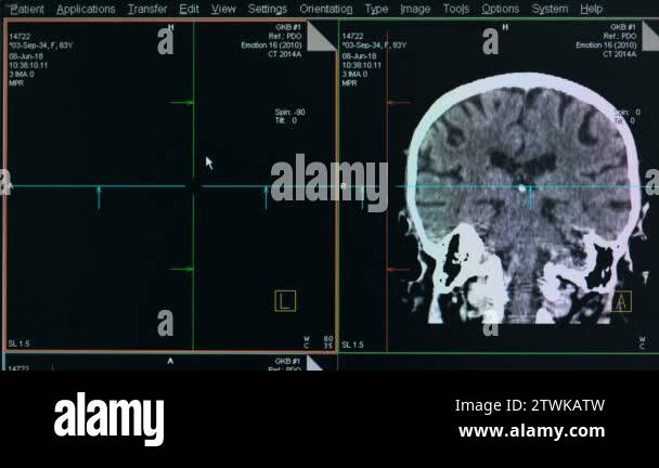Process of brain scanning, close up Stock Video Footage - Alamy