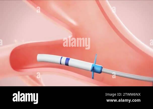 Balloon angioplasty stents procedure Stock Videos & Footage - HD and 4K ...