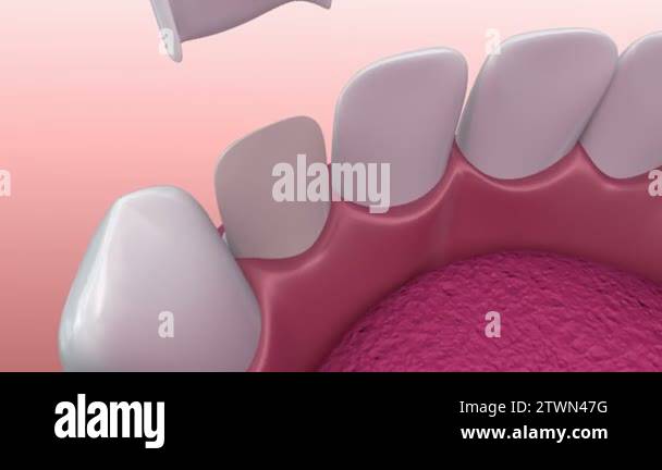 Porcelain veneer Stock Videos & Footage - HD and 4K Video Clips - Alamy